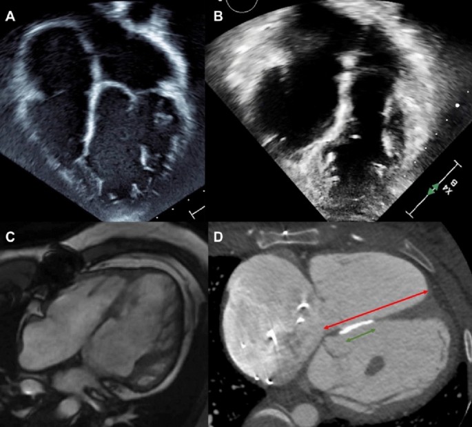 Ventricular Septation of the Double-Inlet Ventricle: Over Three Decades ...