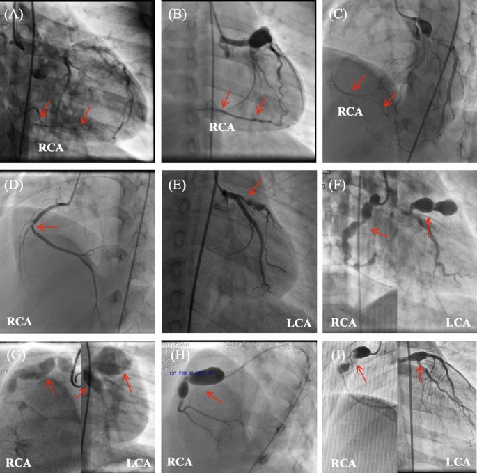 Diagnostic Value of 99mTc-MIBI Myocardial Perfusion Imaging in ...