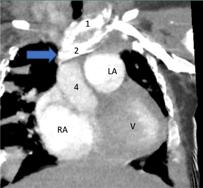 Brachiocephalic Vein Duplication: Case Report of a Double Left ...