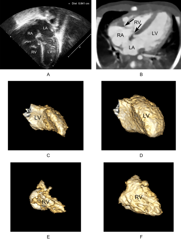 Pulmonary Atresia with Intact Ventricular Septum: Correlation of ...