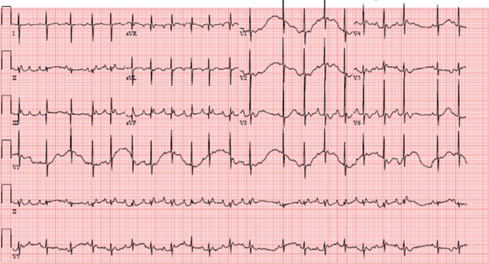 Atrial Arrhythmia and Bradycardia as a Presentation of Congenital Long ...