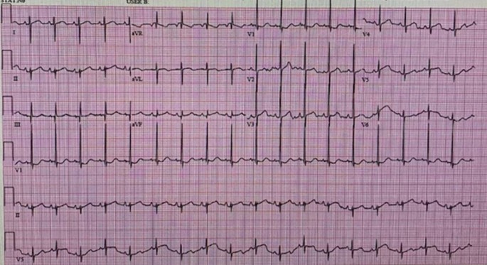 Atrial Arrhythmia and Bradycardia as a Presentation of Congenital Long ...