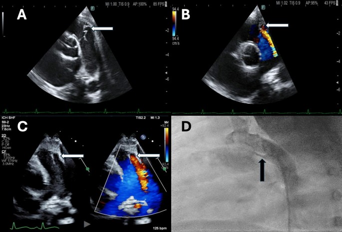 Pulmonary Valve Aneurysm Associated with a Patent Ductus Arteriosus ...