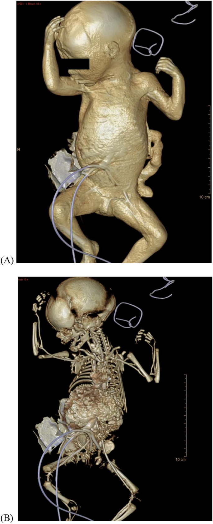 Virtual Post Mortem in Fetuses and Newborns for the Verification of ...