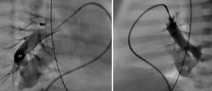 Neonatal Transcatheter Closure of a Large Pulmonary Arteriovenous ...