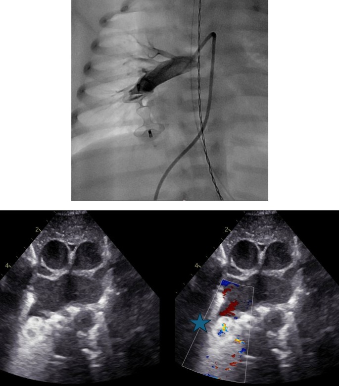Neonatal Transcatheter Closure of a Large Pulmonary Arteriovenous ...