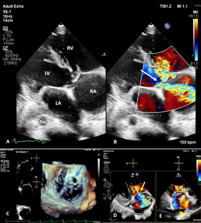 The Heart Under Pressure: Traumatic Gerbode Defect and Aortic ...