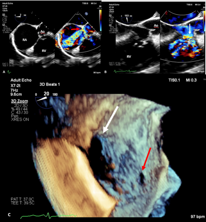 The Heart Under Pressure: Traumatic Gerbode Defect and Aortic ...