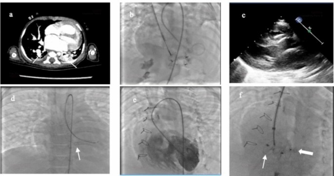 Transcatheter Ventricular Septal Defect Closure in Children