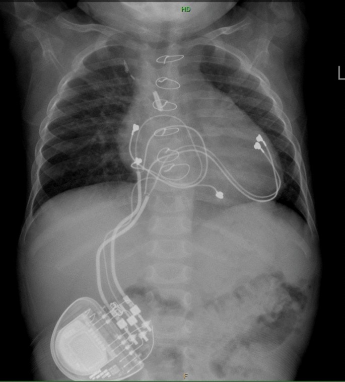 Cardiac Resynchronization Therapy to Aid Ventricular Assist Device ...