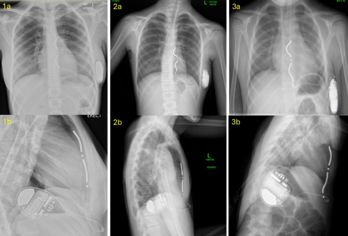 Initial Experience of the Medtronic Aurora Extravascular Implantable ...