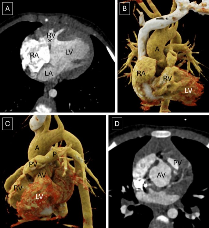 Clarifying the Cardiovascular Morphology and Associated Abnormalities ...