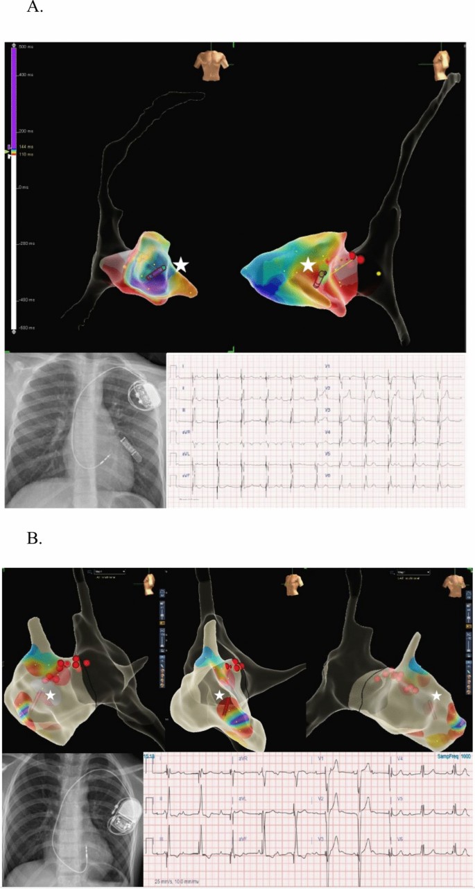 Pediatric Pacing from Proximal Right Ventricular Septum: Preserved Left ...