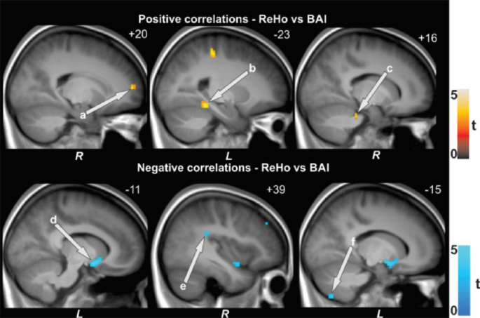 Neural Changes in Adolescents with Single Ventricle Congenital Heart ...