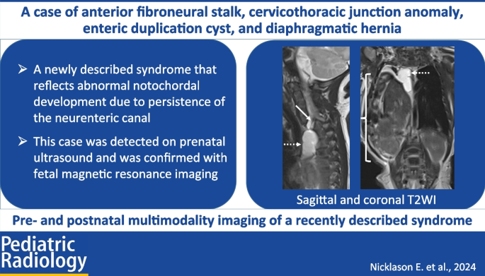 A case of anterior fibroneural stalk, cervicothoracic junction anomaly ...