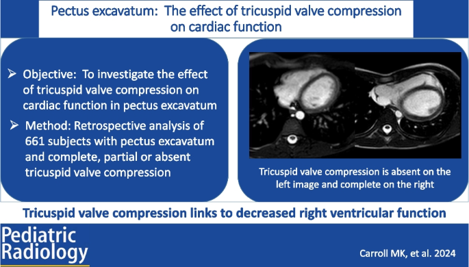 Pectus excavatum: the effect of tricuspid valve compression on cardiac ...
