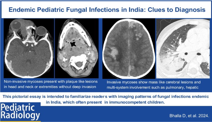 Endemic pediatric fungal infections in India: clues to diagnosis ...