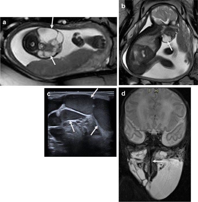 Magnetic resonance imaging of fetal vascular malformations | Pediatric ...