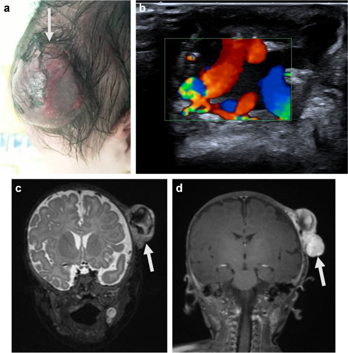 Magnetic resonance imaging of fetal vascular malformations | Pediatric ...