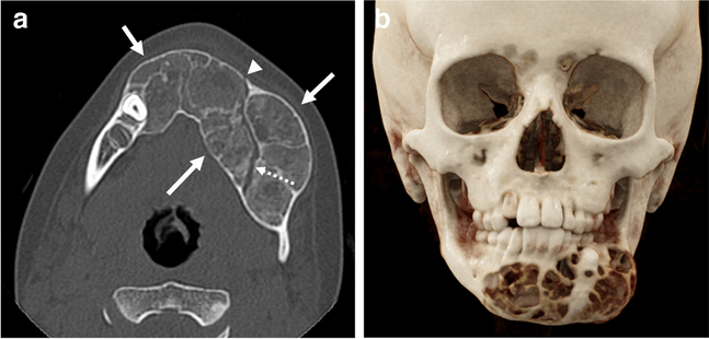 Central giant cell granuloma of the mandible | Pediatric Radiology