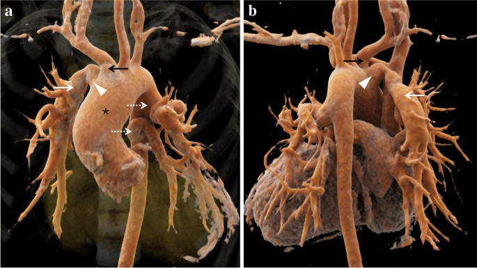 Van Praagh type A3 truncus arteriosus | Pediatric Radiology