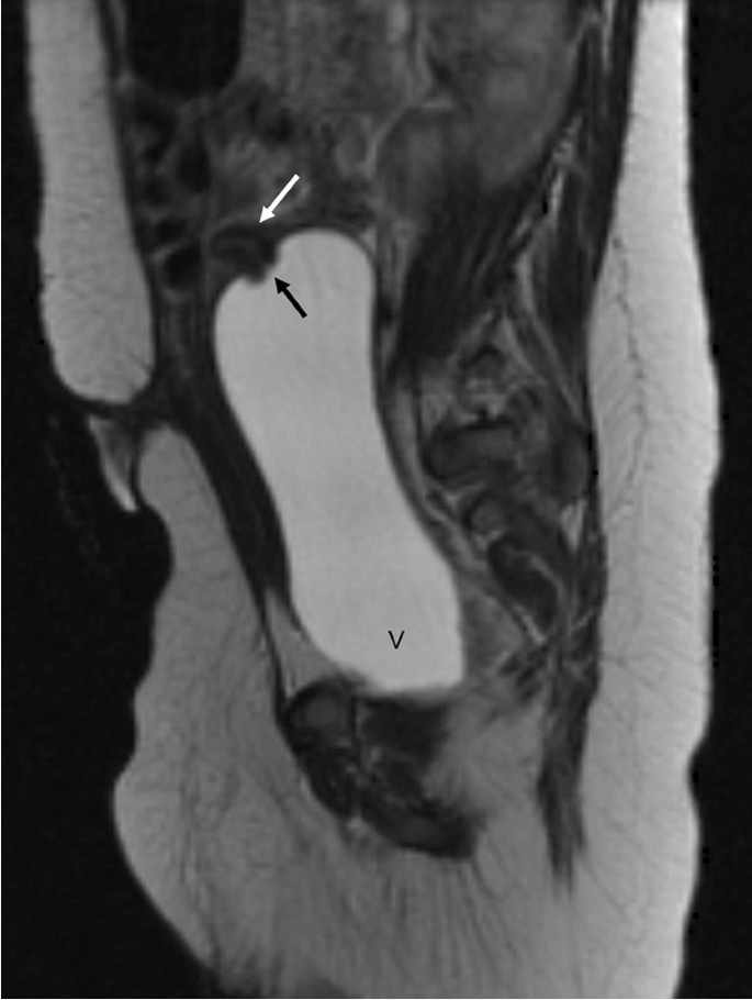 Prenatal hydrocolpos: imaging findings and differential diagnosis ...