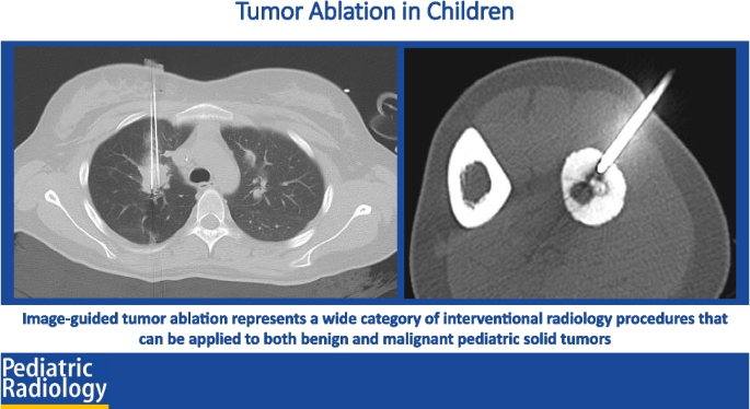 Tumor ablation in children | Pediatric Radiology