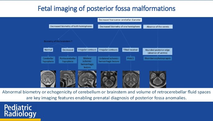 Fetal imaging of posterior fossa malformations | Pediatric Radiology