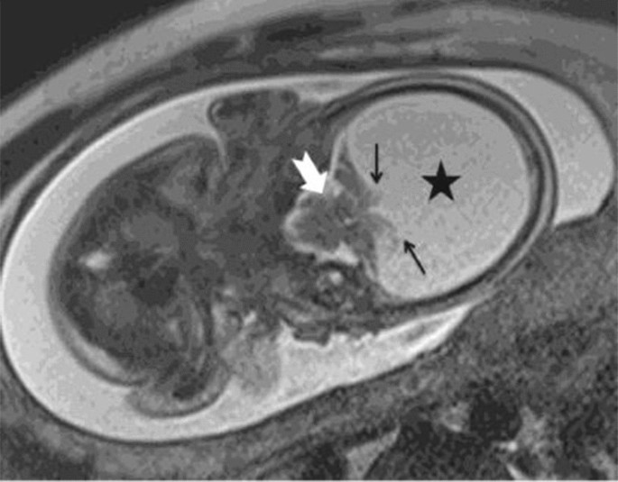 Cerebrolith in hydranencephaly | Pediatric Radiology