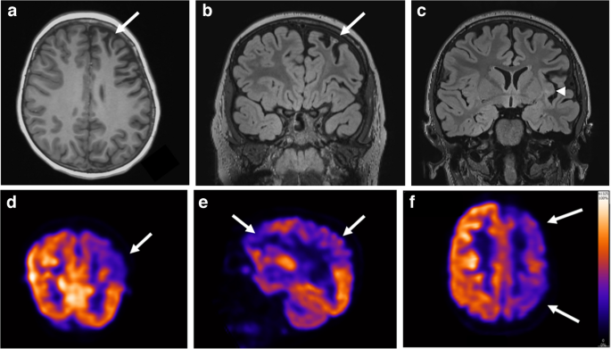 Rasmussen encephalitis: brain MRI and 18F-FDG PET findings | Pediatric ...