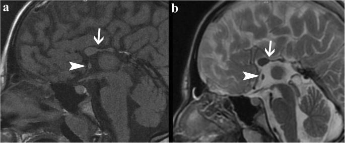 Residual callosal rostrum mimicking a hypothalamic hamartoma ...