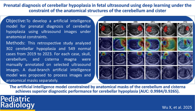Prenatal diagnosis of cerebellar hypoplasia in fetal ultrasound using deep learning under the ...