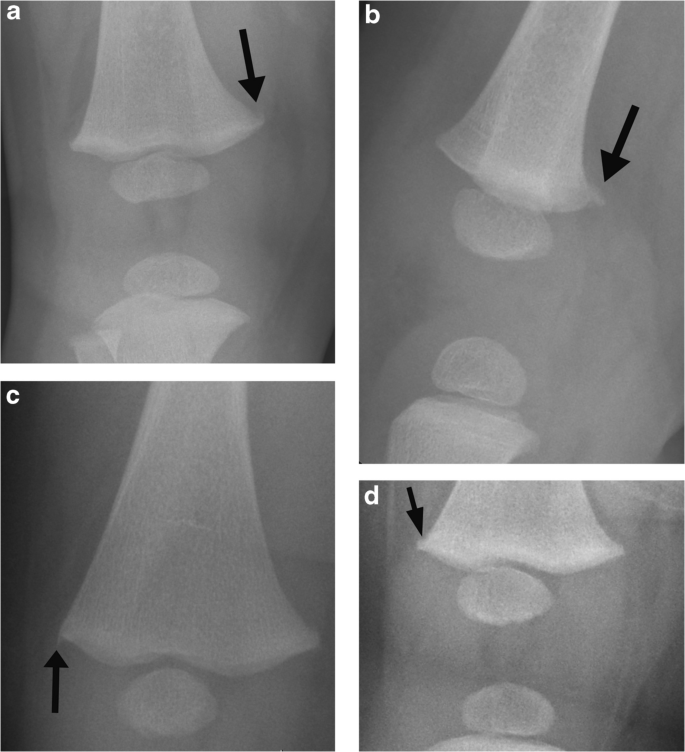 Can metaphyseal variations in the distal femurs and proximal tibias be ...