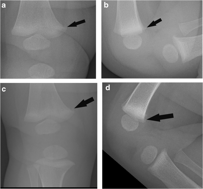 Can metaphyseal variations in the distal femurs and proximal tibias be ...