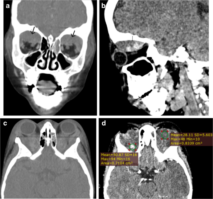 When sickle cell disease strikes the orbits: a rare pediatric case of ...