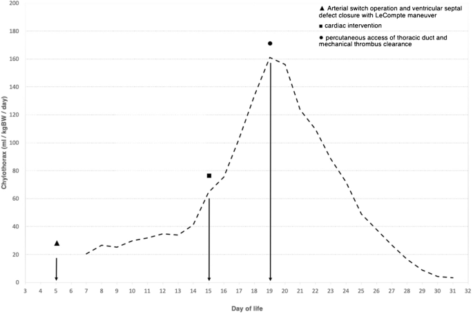 Direct percutaneous access of the thoracic duct in a neonate as ...
