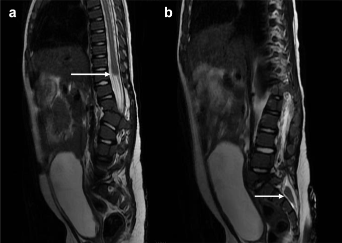 Segmental spinal dysgenesis – a rare type of spinal dysraphism ...