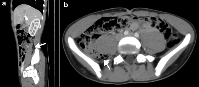 Retropsoas appendix vermiformis: two incidentally detected pediatric ...