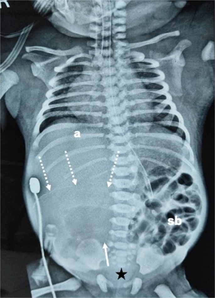 Untwisting the diagnosis: antenatal detection of caecal volvulus ...