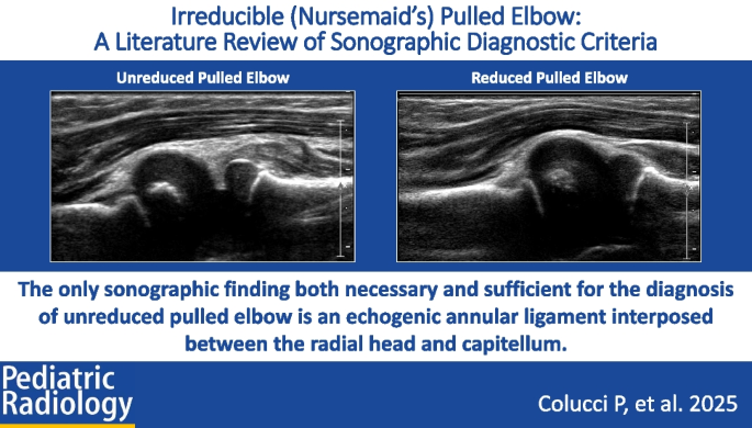 Irreducible (nursemaid’s) pulled elbow: a literature review of ...