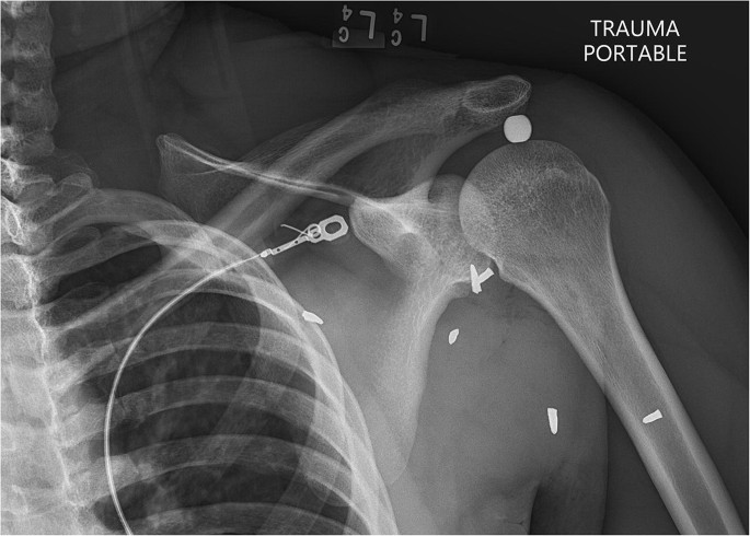 The G2 research R.I.P. fragmenting bullet—radiographic features of a ...