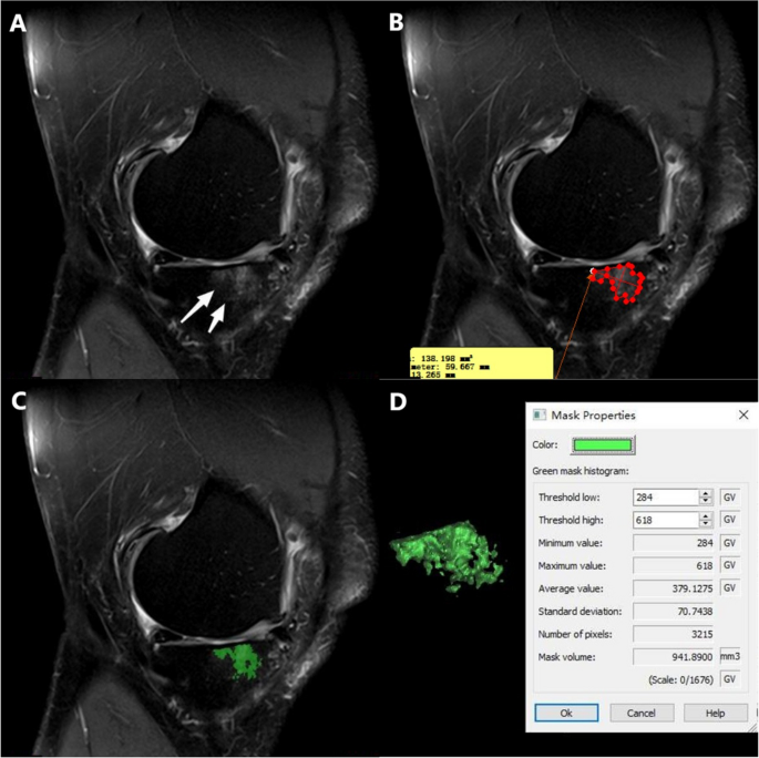 Bone marrow lesions in osteoarthritis: biomarker or treatment target? A ...
