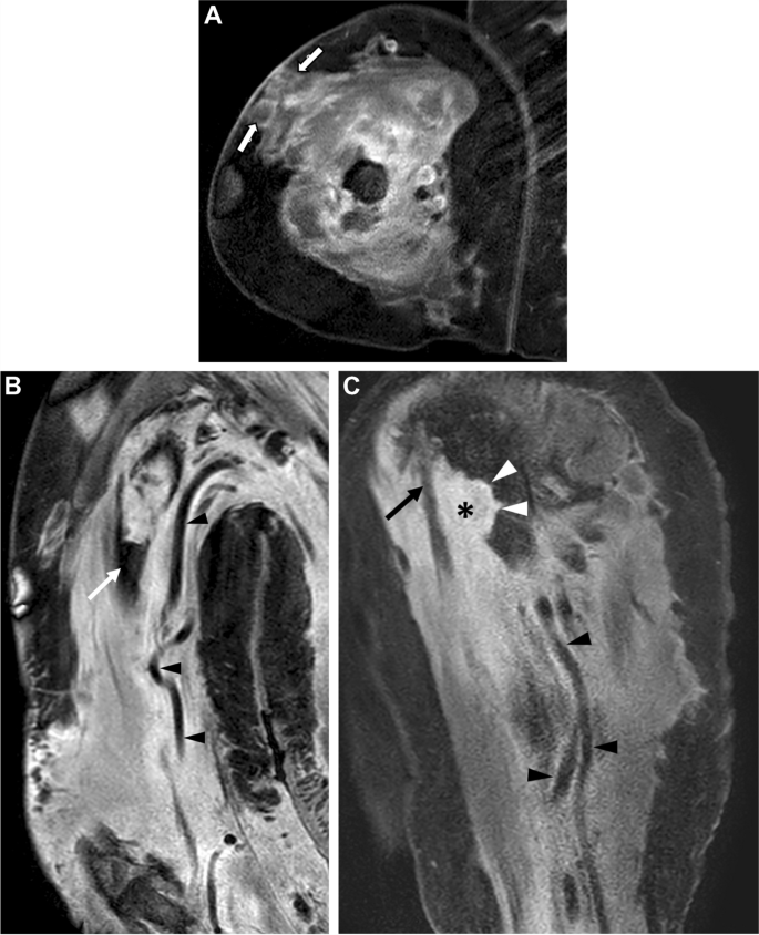Soft tissue hemangioma of the right upper extremity with intraosseous ...