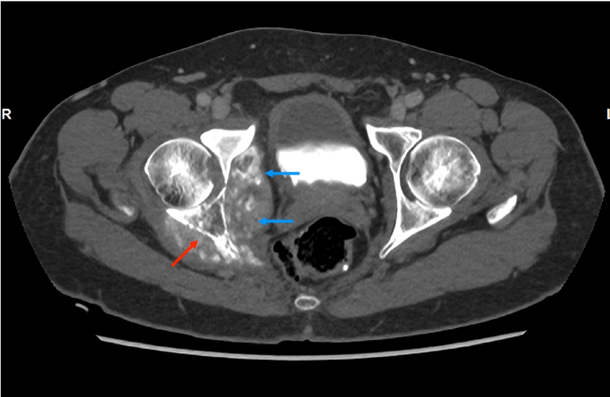 Answer To Test Yourself Answer: Radiation-induced osteosarcoma with ...