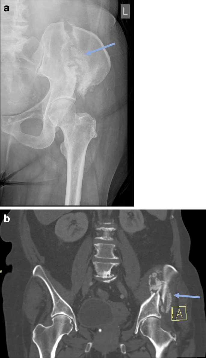 Severe atypical iliac wing fracture associated with long-term ...