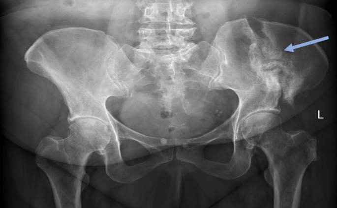 Severe atypical iliac wing fracture associated with long-term ...