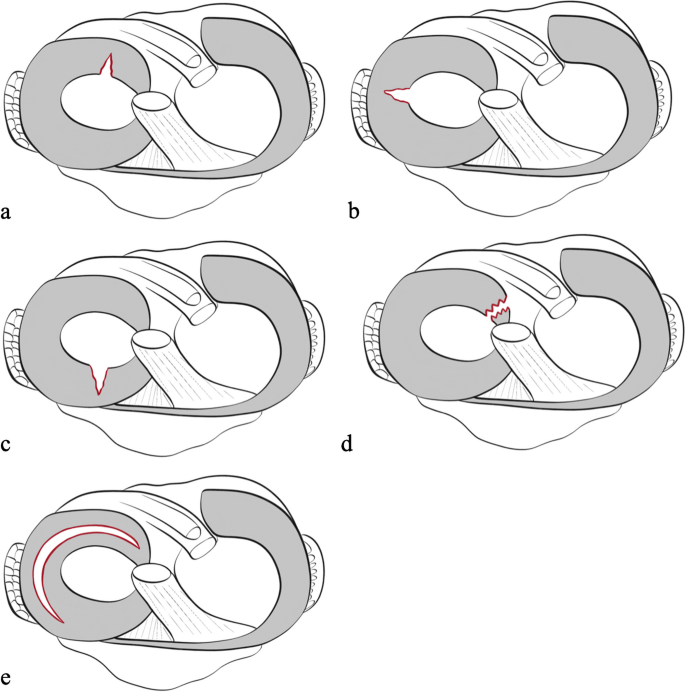 Risk factors for false positive and false negative MRI in diagnosing ...