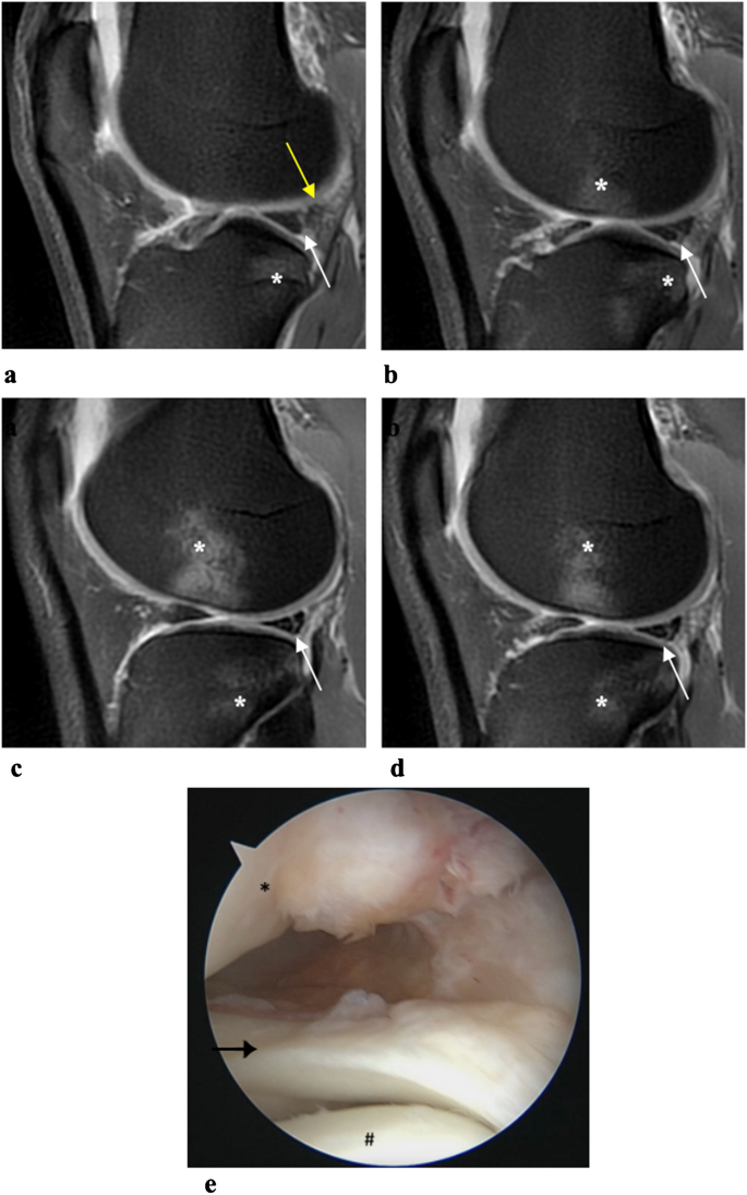 Risk factors for false positive and false negative MRI in diagnosing ...