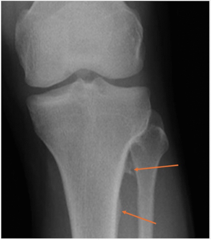 Test yourself answer: Left knee pain in a young adult | Skeletal Radiology