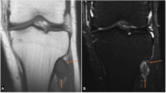 Test yourself answer: Left knee pain in a young adult | Skeletal Radiology